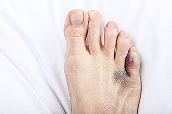 Making Sense of Pinky Toe Pain - The Maryland Gout Institute - Mark E ...
